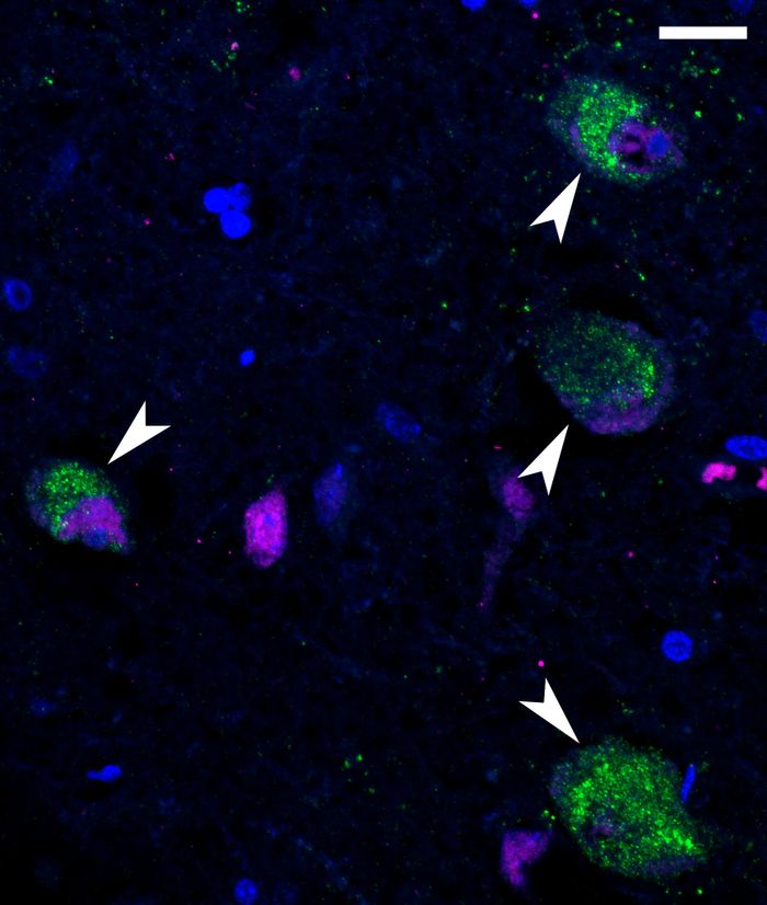 Autopsies Reveal SARS-CoV-2 in the Human Brain & Other Tissues ... Autopsies Reveal SARS-CoV-2 in the Human Brain & Other Tissues ...