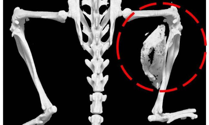 Inflammatory Molecules Linked to Rare Bone Growth Disease | Health And ...