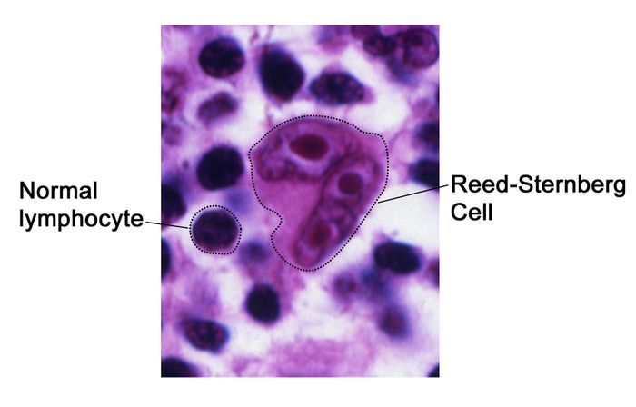 Differences between Hodgkin and non-Hodgkin Lymphoma | Cancer