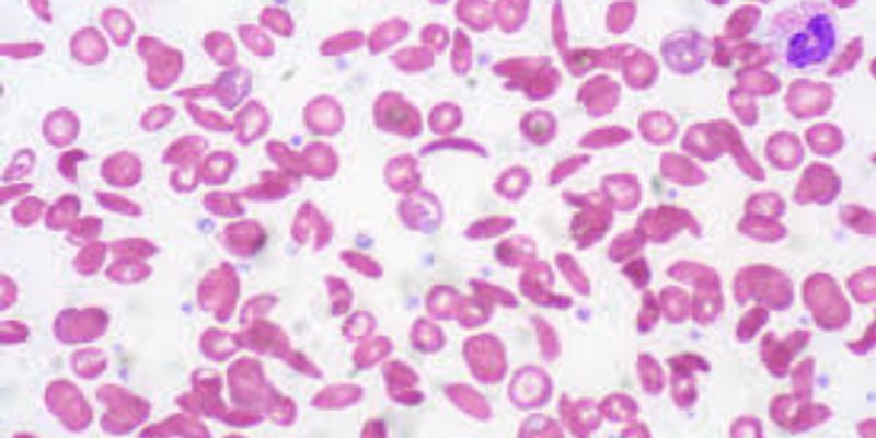 Hemoglobinopathy | | Content Tag